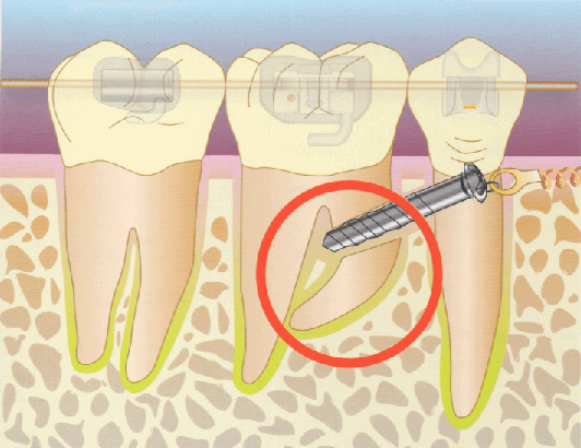 Bio-Ray - A-1 mini Screw - 光哲生技醫療器材有限公司